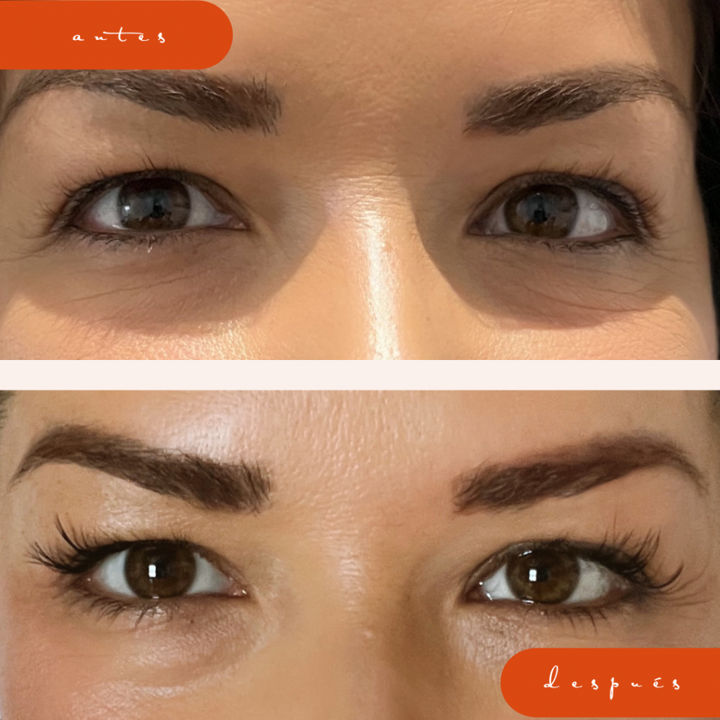 Plasma Pen, la efectiva técnica que sustituye la blefaroplastia en L ...